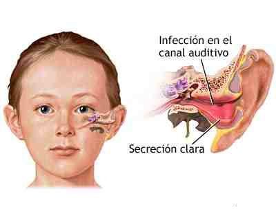 La otitis, sus causas , síntomas y tratamiento.